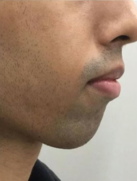 Chin Filler vs Chin Implant: What's the Difference?